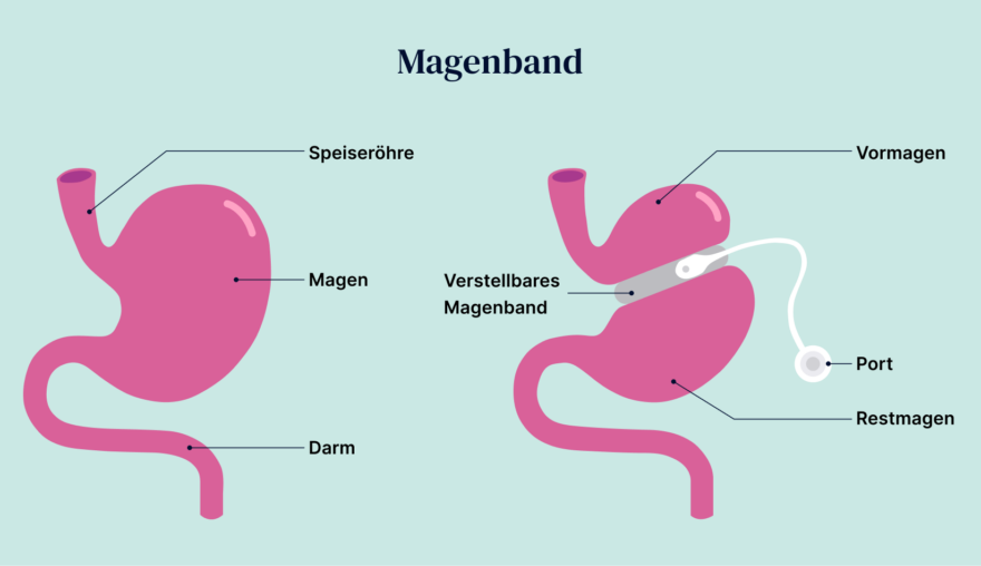 Magenband Ist Die OP F r Mich Geeignet Oviva magenband-ist-die-op-f-r-mich-geeignet-oviva